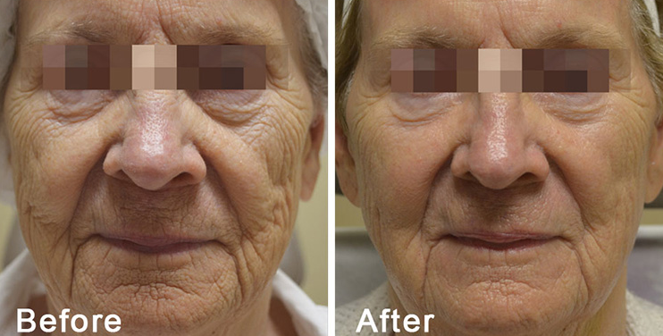 Насадка Fractora Forma до платформи Trinon для ліфтингу та ...