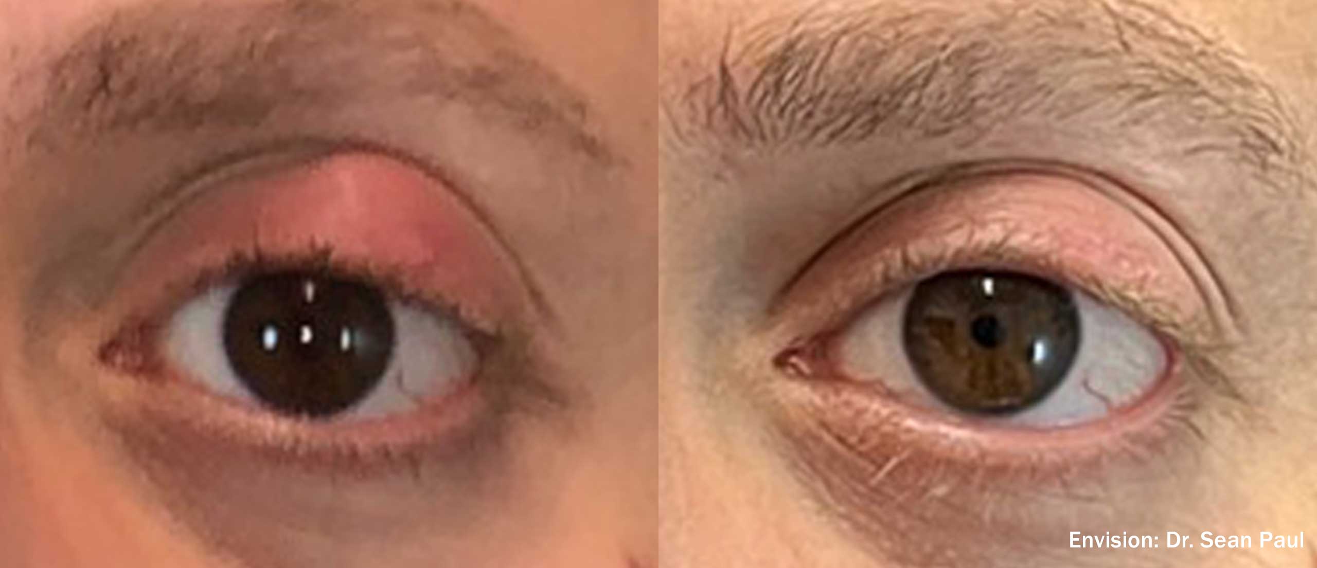 InMode ENVISION платформа для нехірургічного лікування причин сухого ...