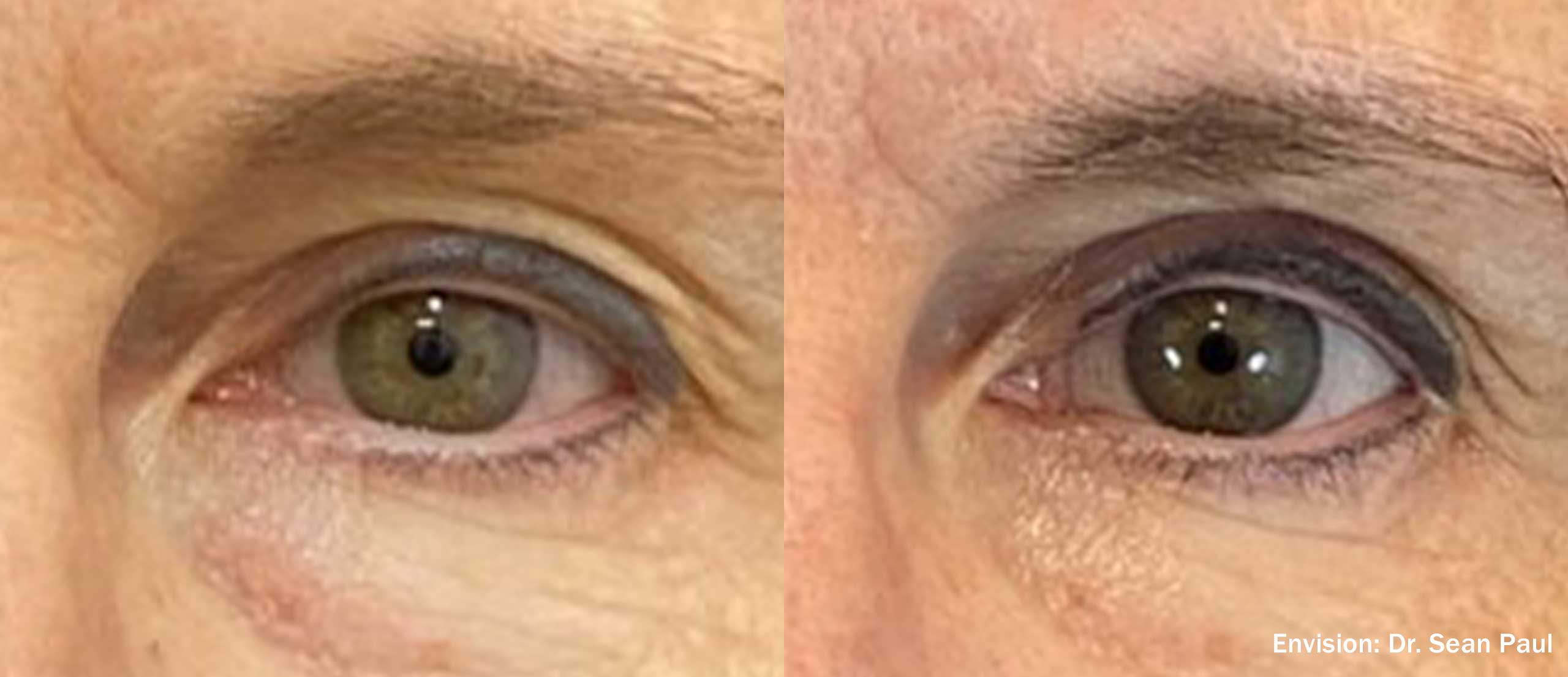 InMode ENVISION платформа для нехірургічного лікування причин сухого ...